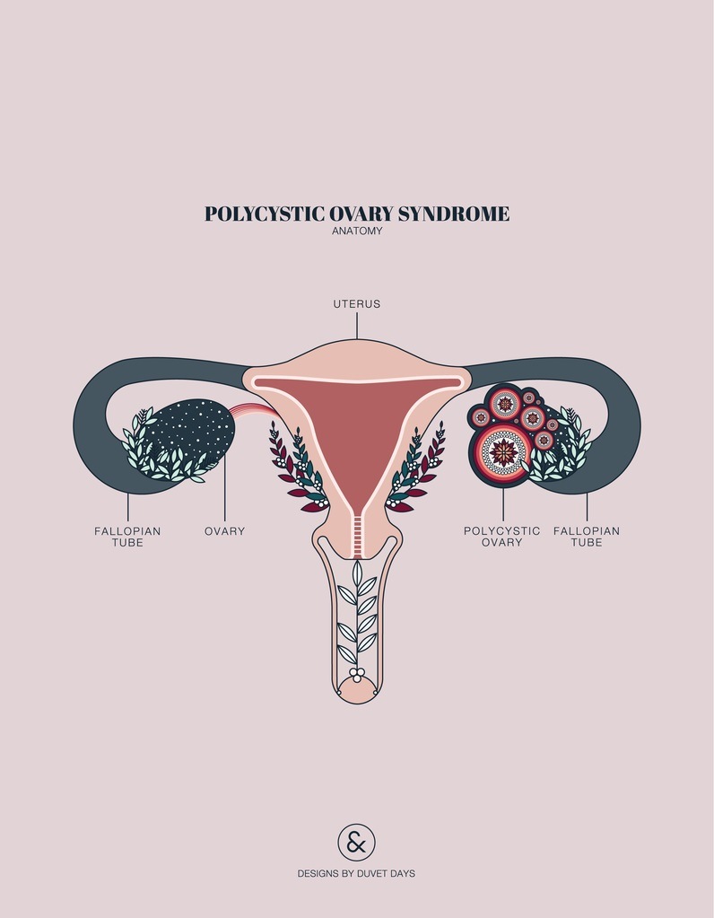 Understanding PCOS - Mornington Chinese Medicine